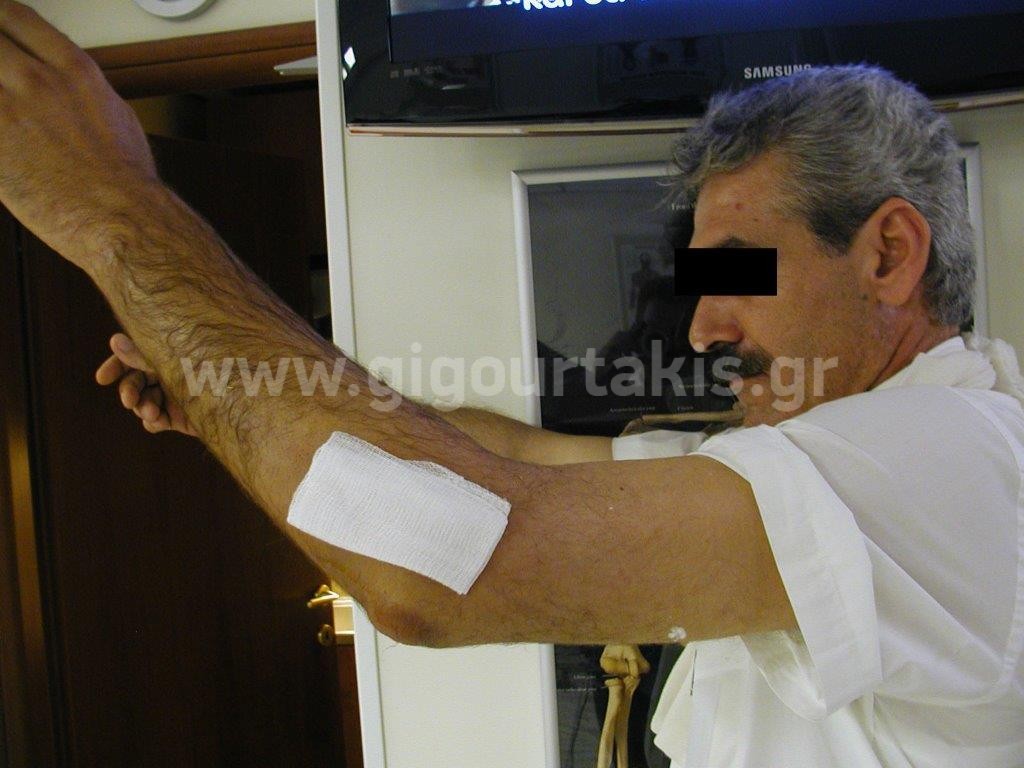 ΚΑΤΑΓΜΑ ΚΕΦΑΛΗΣ ΚΕΡΚΙΔΟΣ - Φυσικοθεραπευτήριο Σπύρος Γιγουρτάκης