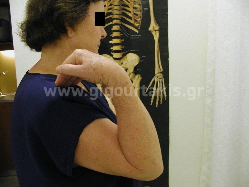 ΚΑΤΑΓΜΑ ΕΣΩ ΚΟΝΔΥΛΟΥ - Φυσικοθεραπευτήριο Σπύρος Γιγουρτάκης