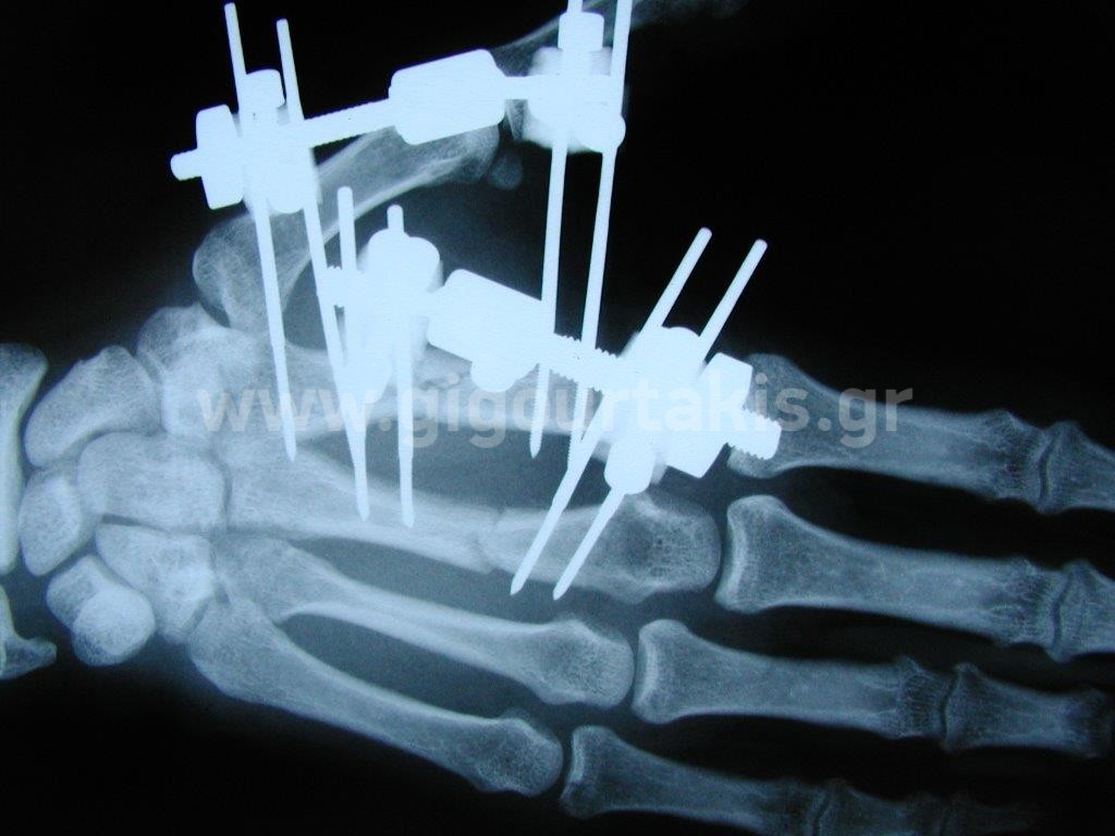 ΚΑΤΑΓΜΑ ΜΕΤΑΚΑΡΠΙΩΝ - Φυσικοθεραπευτήριο Σπύρος Γιγουρτάκης