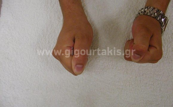 ΚΑΤΑΓΜΑ ΠΗΧΕΟΚΑΡΠΙΚΗΣ - Φυσικοθεραπευτήριο Σπύρος Γιγουρτάκης