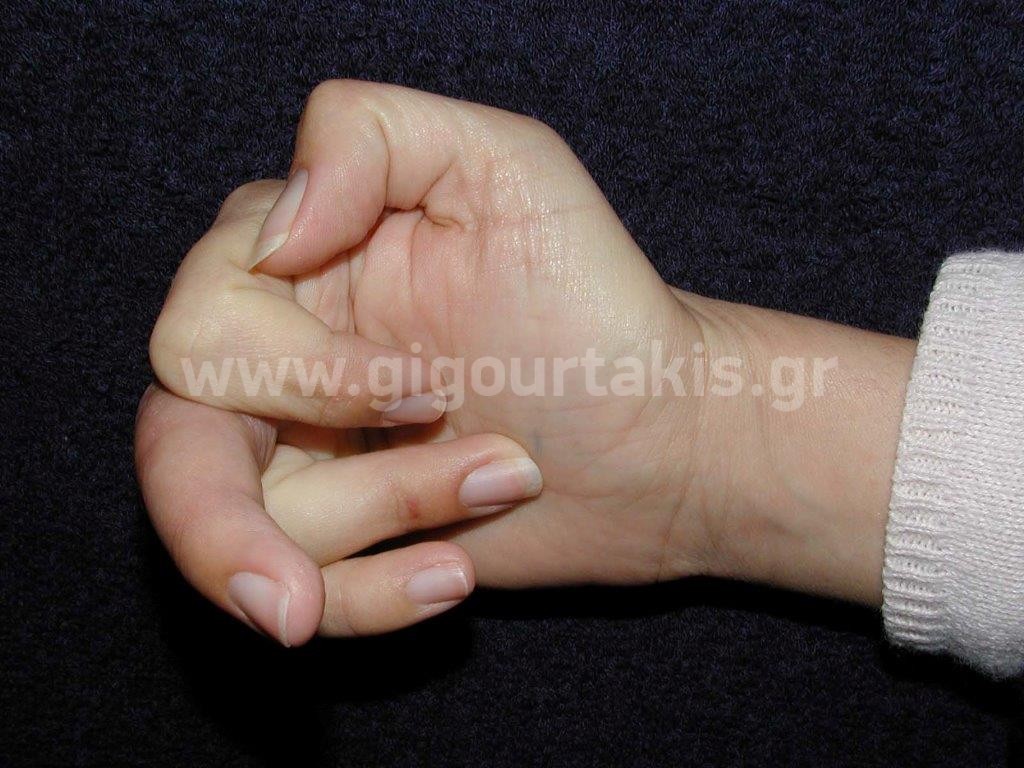ΔΙΑΤΟΜΗ ΤΕΝΟΝΤΩΝ - Φυσικοθεραπευτήριο Σπύρος Γιγουρτάκης