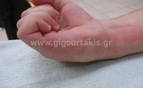 ΚΑΤΑΓΜΑ ΜΕΤΑΚΑΡΠΙΩΝ - Φυσικοθεραπευτήριο Σπύρος Γιγουρτάκης