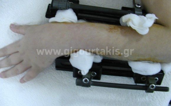 ΕΠΙΜΗΚΥΝΣΗ ΠΗΧΕΩΣ - Φυσικοθεραπευτήριο Σπύρος Γιγουρτάκης