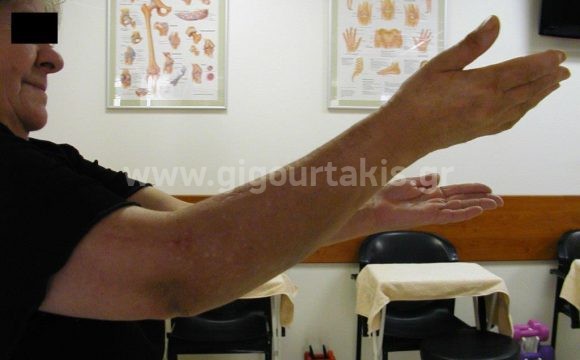 ΕΞΑΡΘΡΗΜΑ ΑΓΚΩΝΟΣ - Φυσικοθεραπευτήριο Σπύρος Γιγουρτάκης