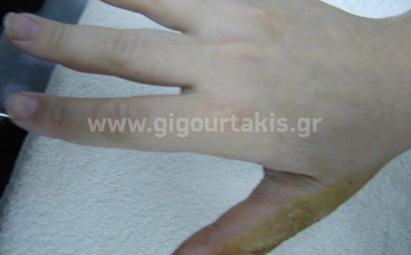 ΕΓΧΟΡΔΩΜΑ - Φυσικοθεραπευτήριο Σπύρος Γιγουρτάκης