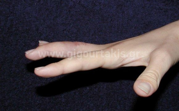 ΔΙΑΤΟΜΗ ΤΕΝΟΝΤΩΝ - Φυσικοθεραπευτήριο Σπύρος Γιγουρτάκης