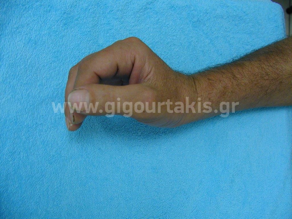 ΚΑΚΩΣΕΙΣ -ΠΑΡΕΣΗ ΝΕΥΡΙΚΟΥ ΙΣΤΟΥ - Φυσικοθεραπευτήριο Σπύρος Γιγουρτάκης