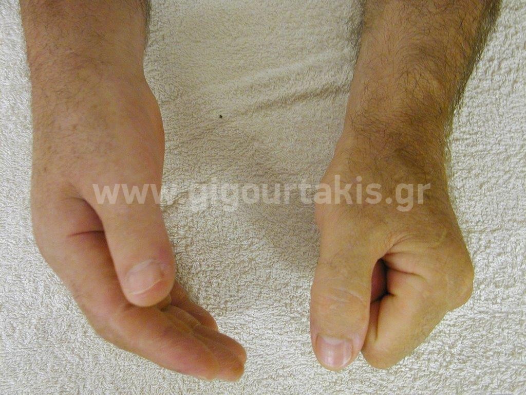 ΔΙΑΤΟΜΗ ΤΕΝΟΝΤΩΝ - Φυσικοθεραπευτήριο Σπύρος Γιγουρτάκης