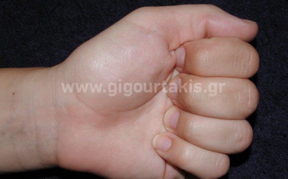 ΕΠΙΜΗΚΥΝΣΗ ΜΕΤΑΚΑΡΠΙΩΝ - Φυσικοθεραπευτήριο Σπύρος Γιγουρτάκης