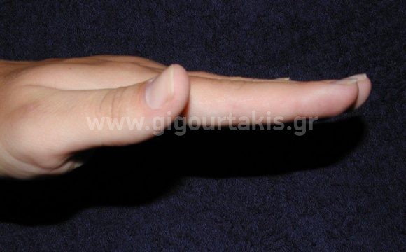 ΕΠΙΜΗΚΥΝΣΗ ΜΕΤΑΚΑΡΠΙΩΝ - Φυσικοθεραπευτήριο Σπύρος Γιγουρτάκης