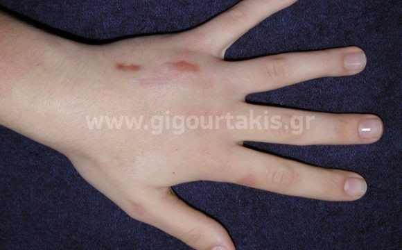 ΕΠΙΜΗΚΥΝΣΗ ΜΕΤΑΚΑΡΠΙΩΝ - Φυσικοθεραπευτήριο Σπύρος Γιγουρτάκης