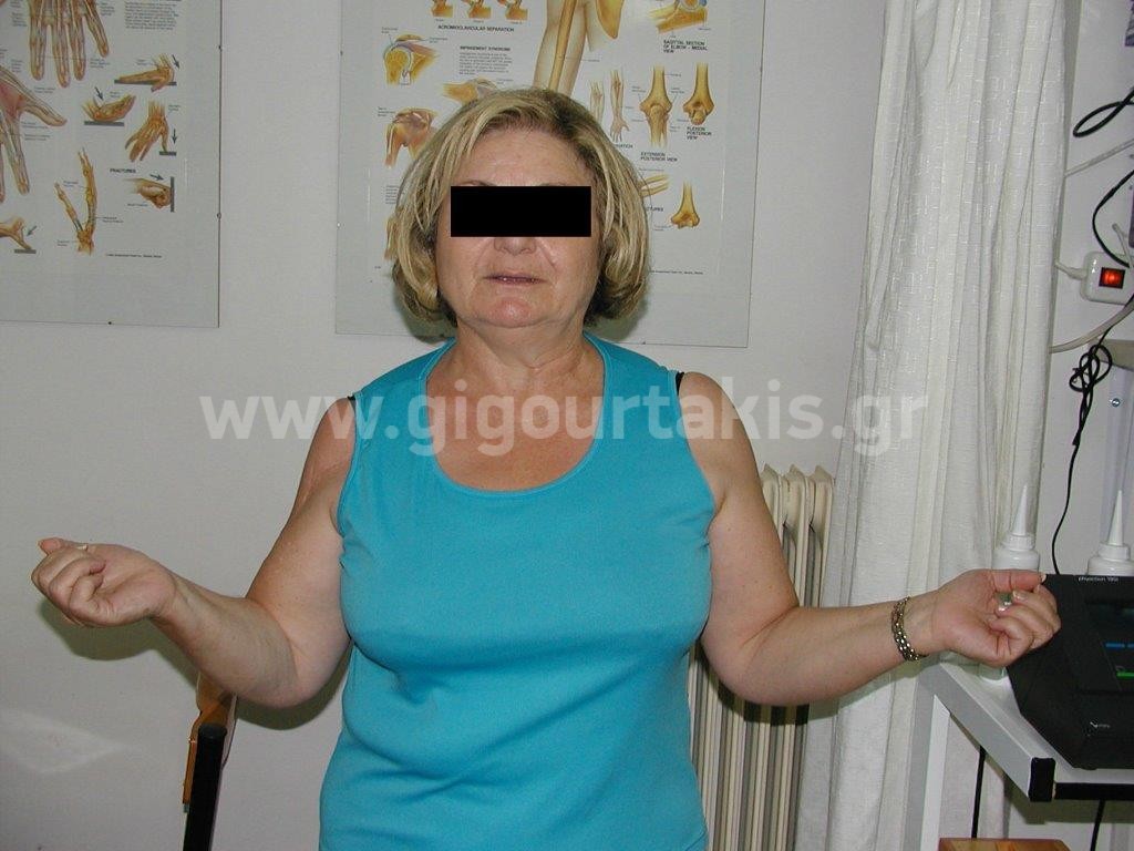 ΨΕΥΔΑΡΘΡΩΣΗ ΒΡΑΧΙΟΝΙΟΥ - Φυσικοθεραπευτήριο Σπύρος Γιγουρτάκης