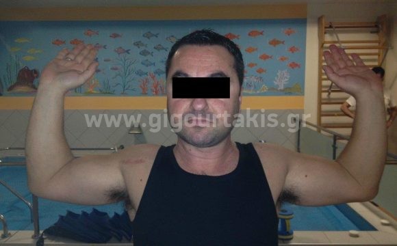 ΔΙΑΤΟΜΗ ΜΑΚΡΑΣ ΚΕΦΑΛΗΣ ΔΙΚΕΦΑΛΟΥ - Φυσικοθεραπευτήριο Σπύρος Γιγουρτάκης